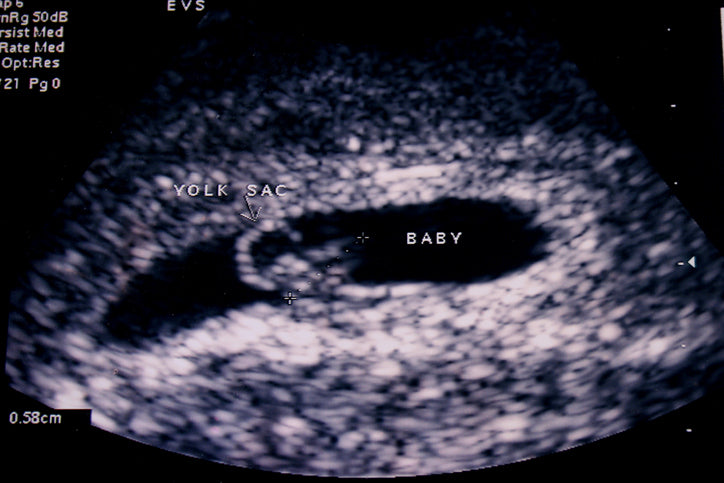 What is a Dating Scan During Pregnancy? – My Baby's Heartbeat Bear